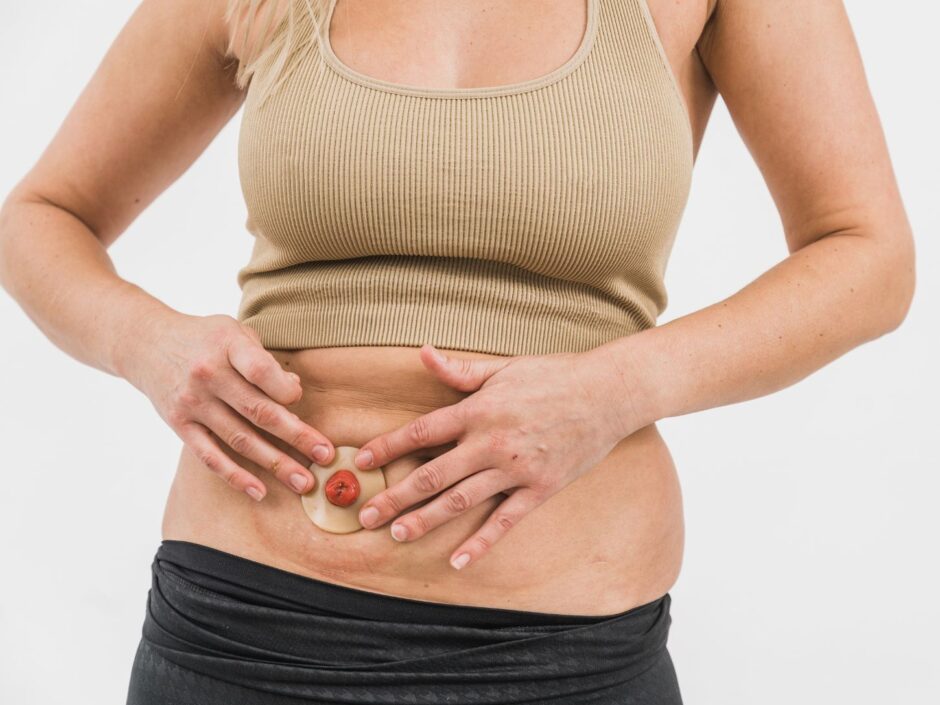 What is a stoma? | CliniMed