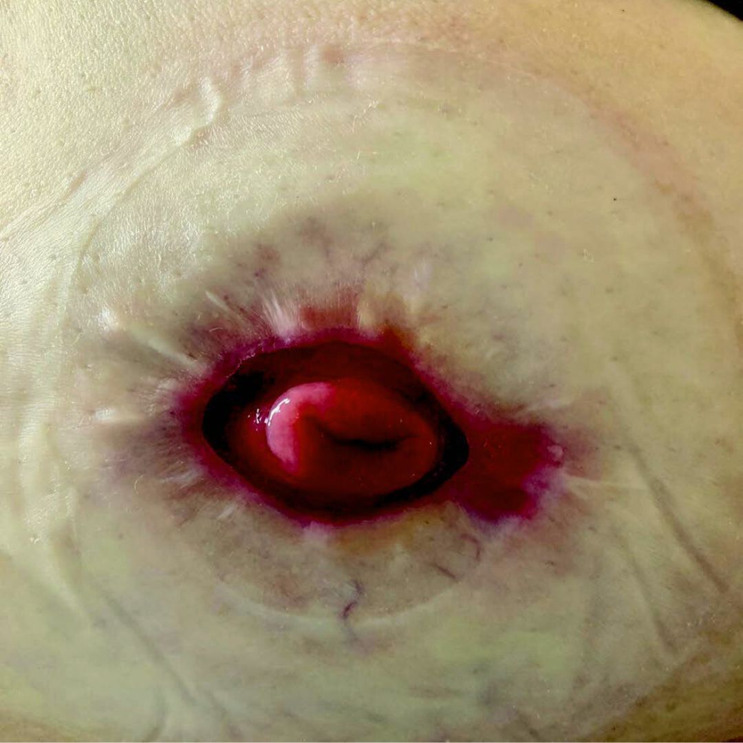 Providing gentle support for a flush stoma | CliniMed